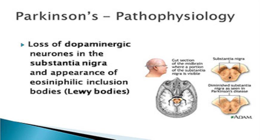 Download Free Medical Parkinsons Disease PowerPoint Presentation