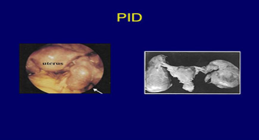 Download Free Medical Pelvic Inflammatory Disease-PID PowerPoint ...