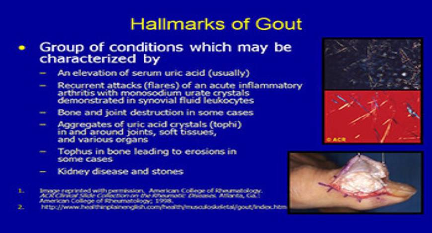 Download Free Medical Clinical Aspects of Gout PowerPoint Presentation