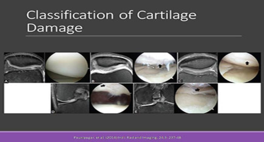 Download Free Medical Cartilage Injury and Surgical Treatment ...