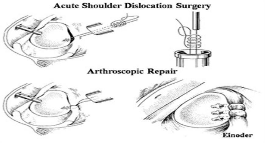 Download Free Medical Acute Anterior Dislocation of The Shoulder ...