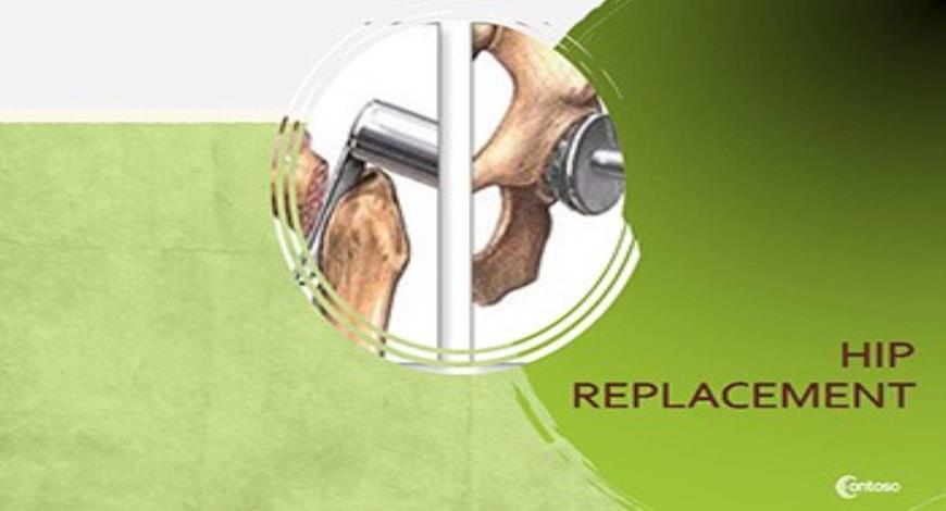 HIP REPLACEMENT Medical Presentation