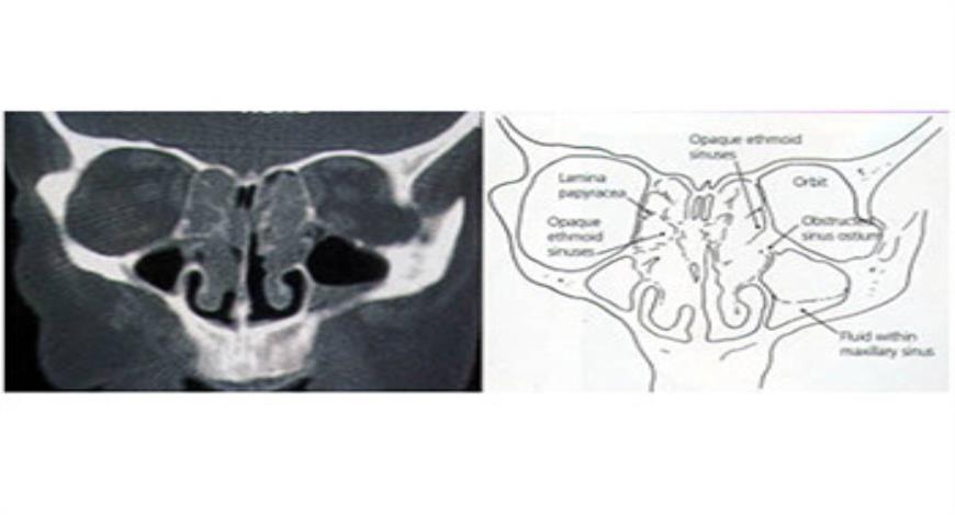 Download Free Medical Nasal Polyposis PowerPoint Presentation