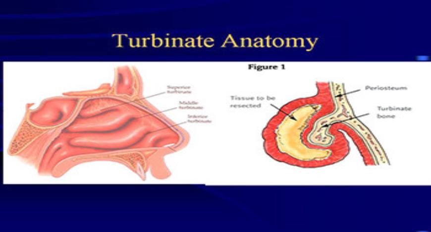 Download Free Medical Pediatric Turbinate Hypertrophy PowerPoint ...
