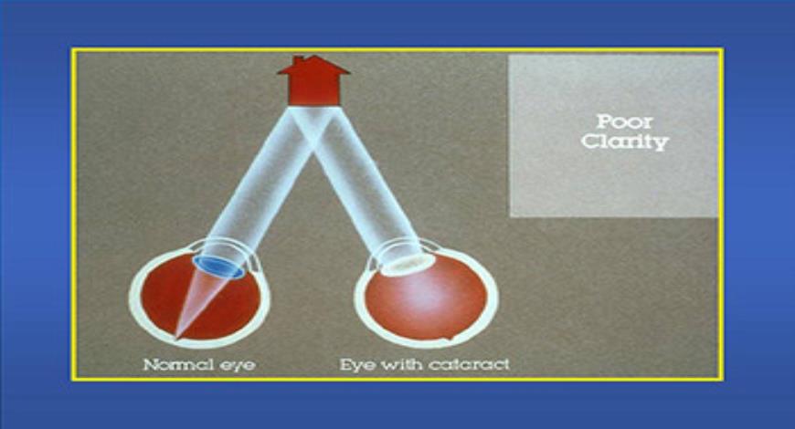 Download Free Medical Amblyopia PowerPoint Presentation
